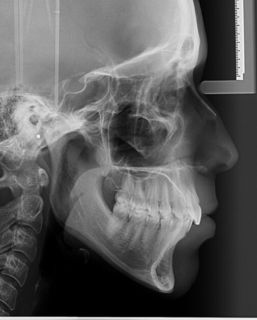 5 Aplicações da Telerradiografia Lateral na Odontologia - Craniofacial